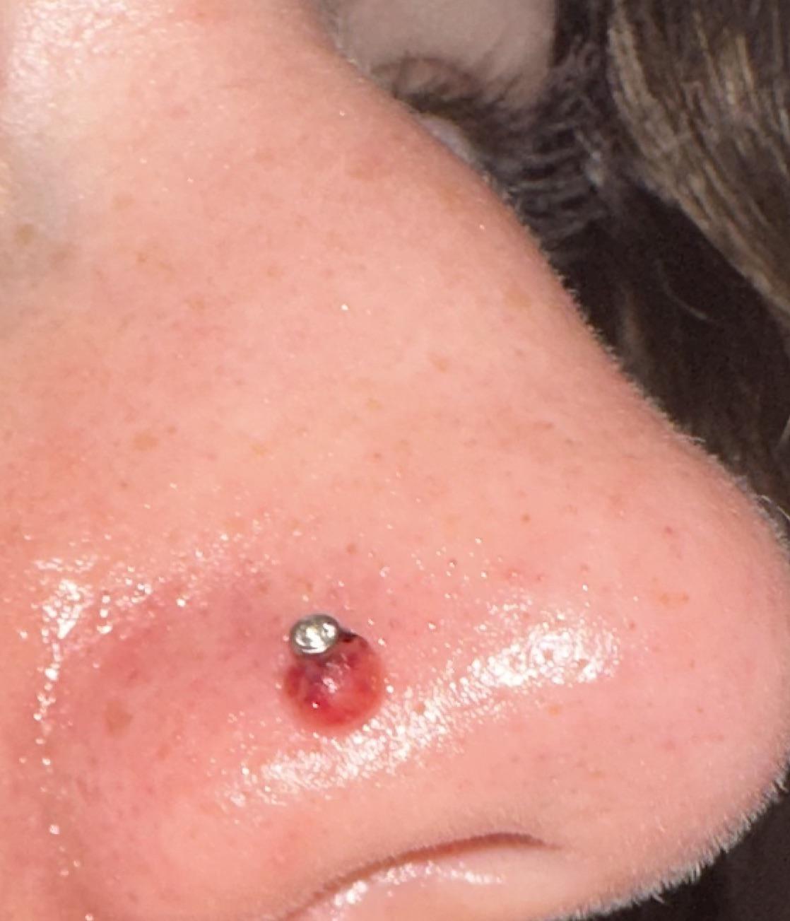 Can a Nose Piercing Infection Kill You? Critical Facts Unveiled