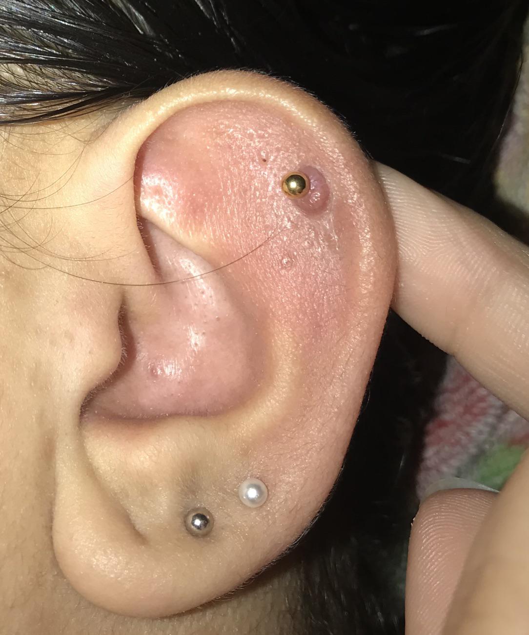 Do Piercing Bumps Go Away? Vanish Unsightly Nodules Fast!